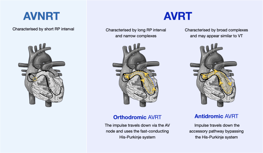 AVNRT vs AVRT - Four Minute Medicine